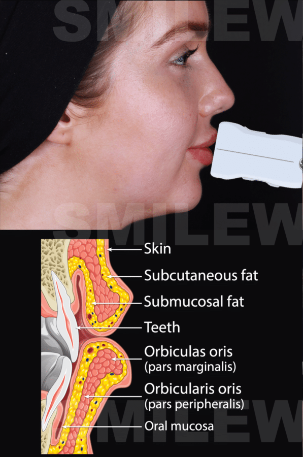 Master Lip Anatomy for Fillers: Inject Better & Grow Your Practice
