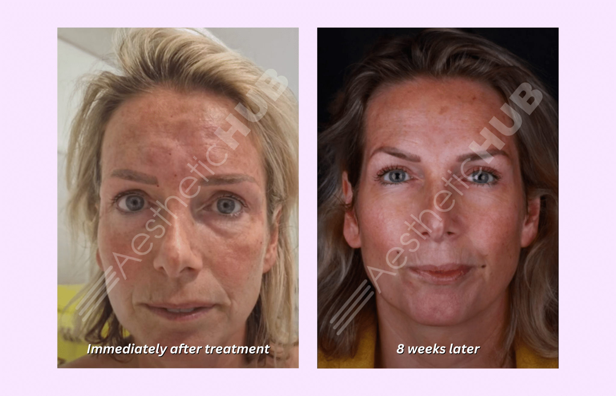 Forehead Fillers Gone Wrong? How to Identify & Fix It