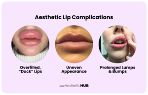8 Signs of Lip Fillers Gone Wrong (And How to Prevent It)