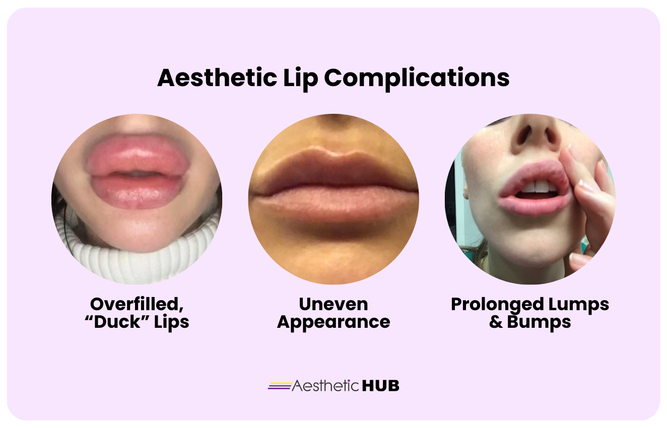 8 Signs of Lip Fillers Gone Wrong (And How to Prevent It)