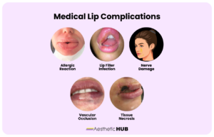 8 Signs of Lip Fillers Gone Wrong (And How to Prevent It)