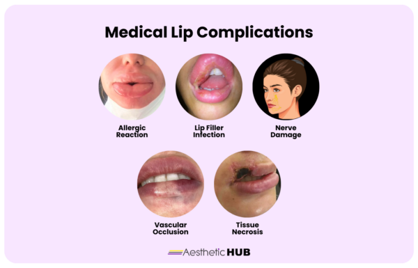 8 Signs of Lip Fillers Gone Wrong (And How to Prevent It)