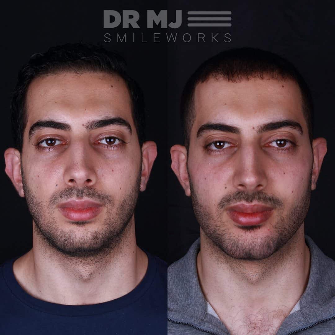 Why Get Fillers for Men? Discover the Top Treatment Areas