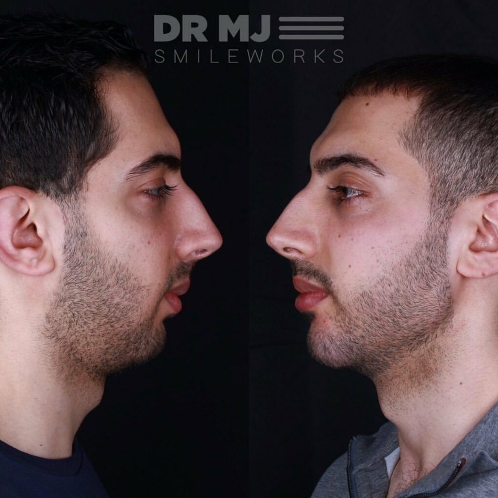 Why Get Fillers for Men? Discover the Top Treatment Areas