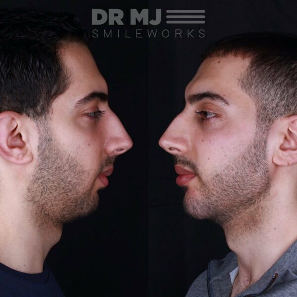Why Get Fillers for Men? Discover the Top Treatment Areas