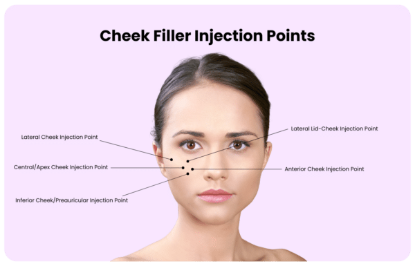 Cheek Filler Injection Points: The Ultimate Treatment Guide
