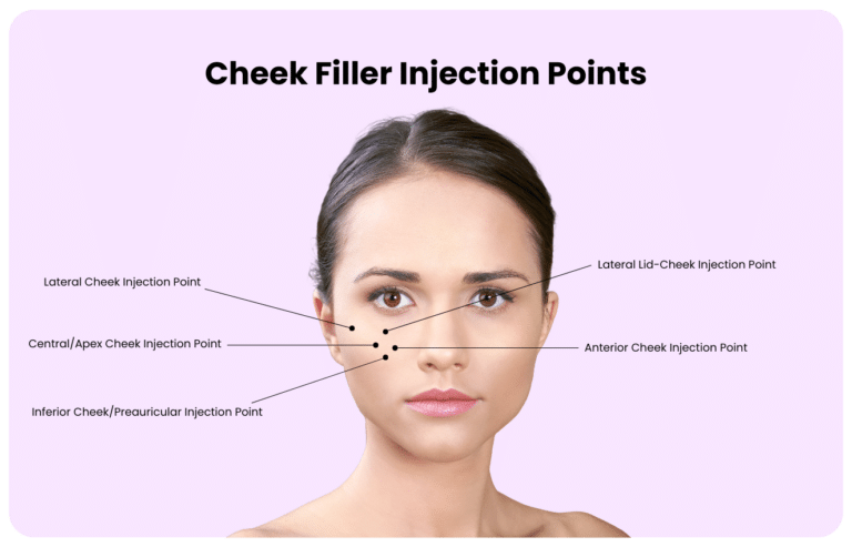 Cheek Filler Injection Points: The Ultimate Treatment Guide
