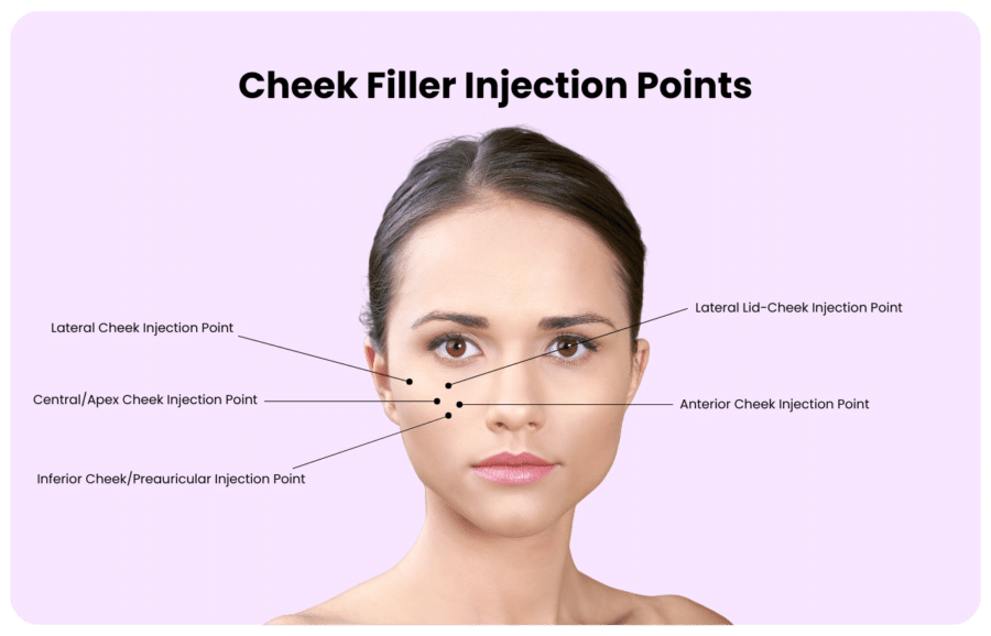 Cheek Filler Injection Points: The Ultimate Treatment Guide