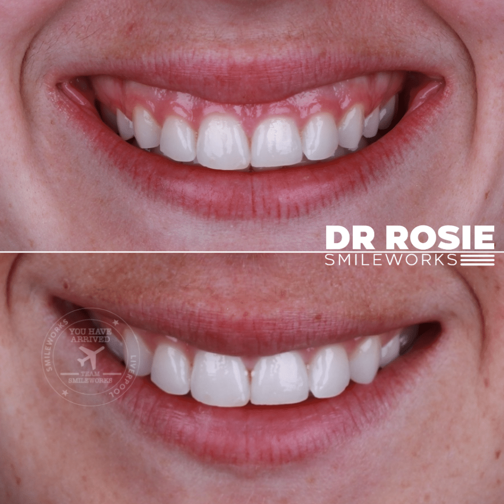Gummy Smile Botox Injection Points | The Best Techniques