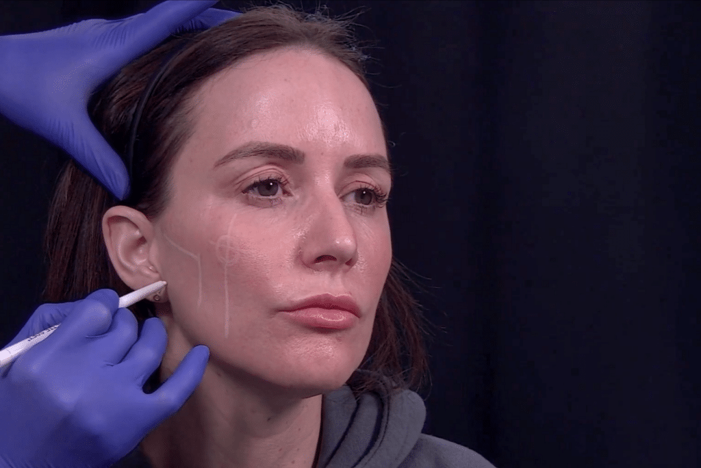 Cheek Filler Injection Points: The Ultimate Treatment Guide