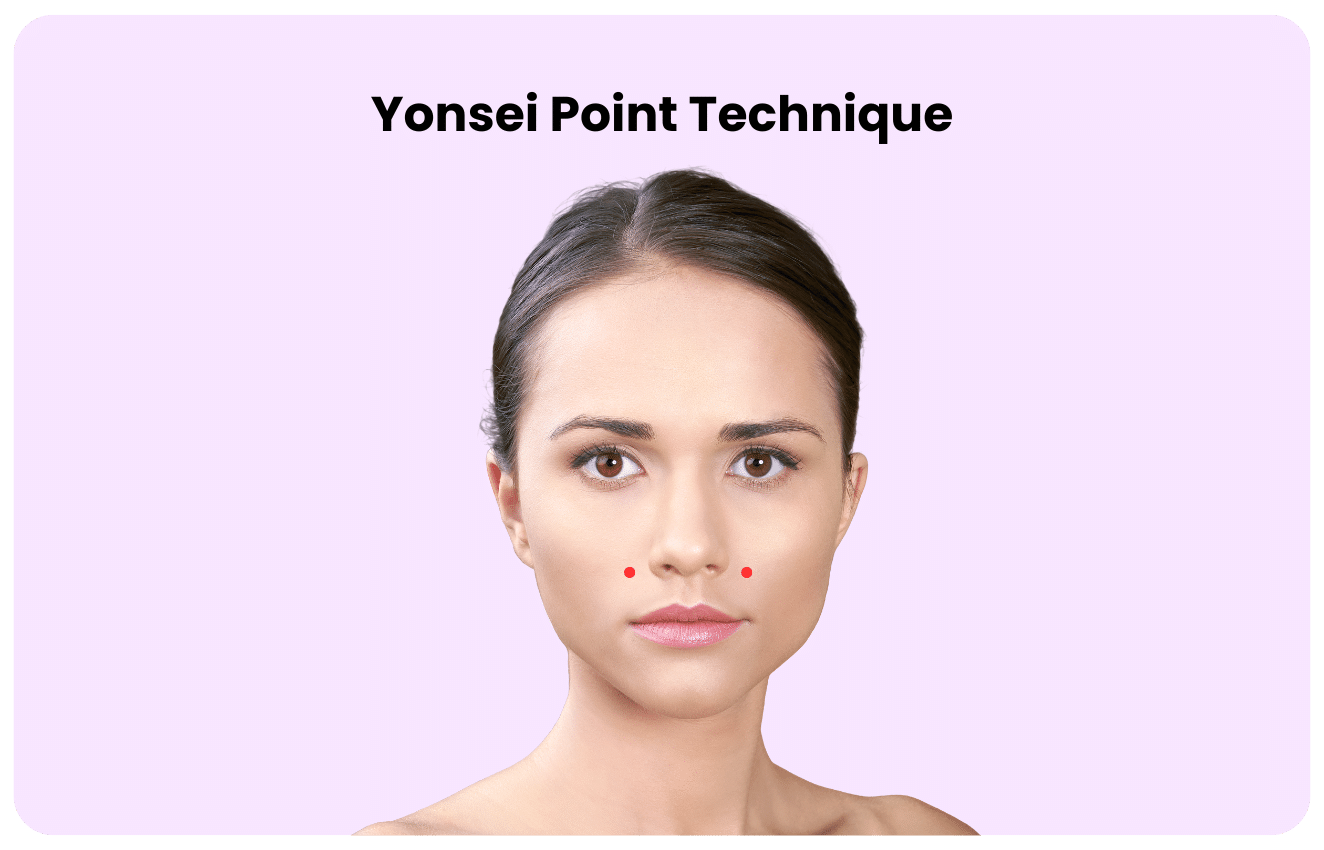 Gummy Smile Botox Injection Points | The Best Techniques
