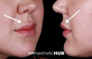 How to Fix Lip Filler Migration: A Practitioner's Guide