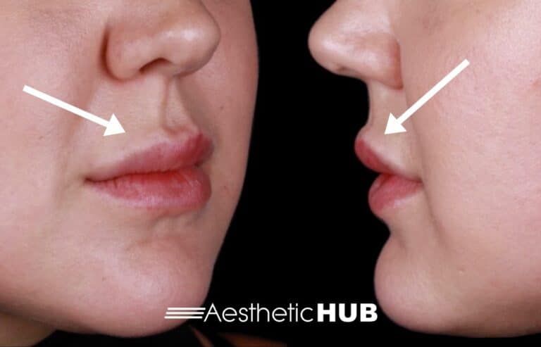 How to Fix Lip Filler Migration: A Practitioner's Guide