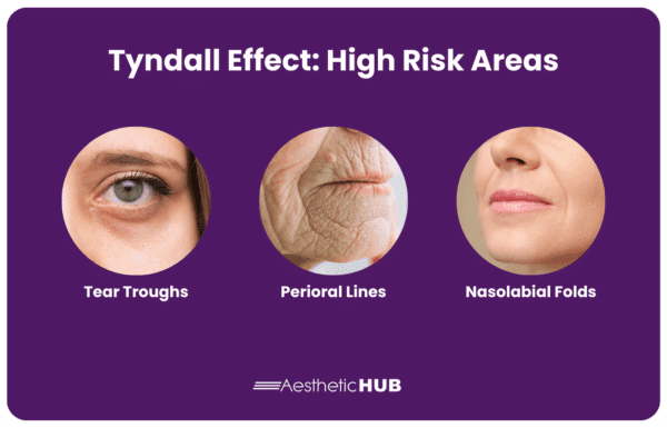 Tyndall Effect in Dermal Fillers: What It Is & How to Prevent It