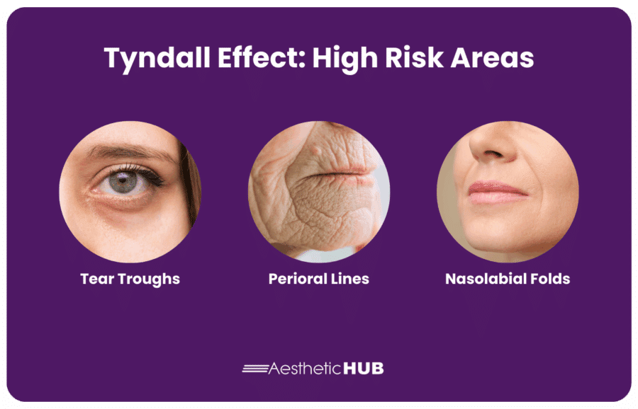 Tyndall Effect in Dermal Fillers: What It Is & How to Prevent It