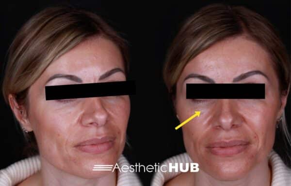 Tyndall Effect in Dermal Fillers: What It Is & How to Prevent It