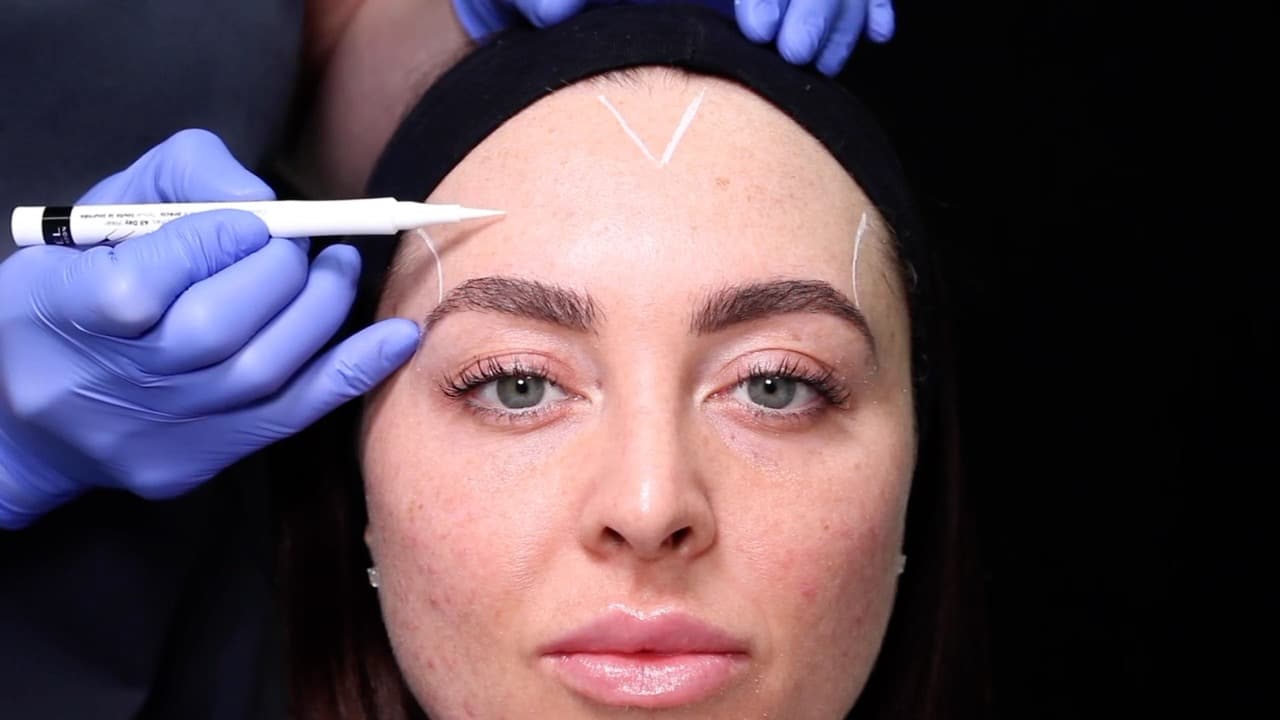Master Botox Forehead Injection Sites: Expert Techniques