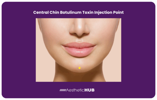 Chin Botox: The Best Fix for Dimpled or Pebbled Chins