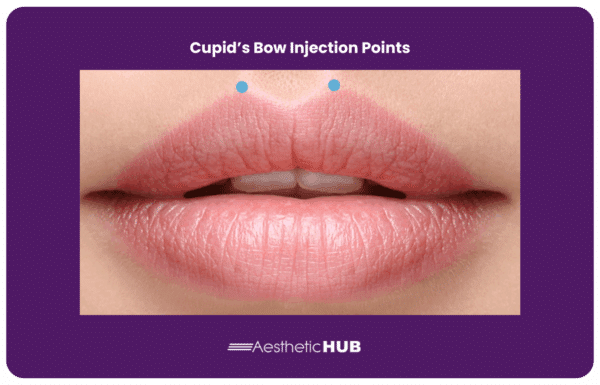 Cupid’s Bow Lip Filler: When & How To Treat This Area