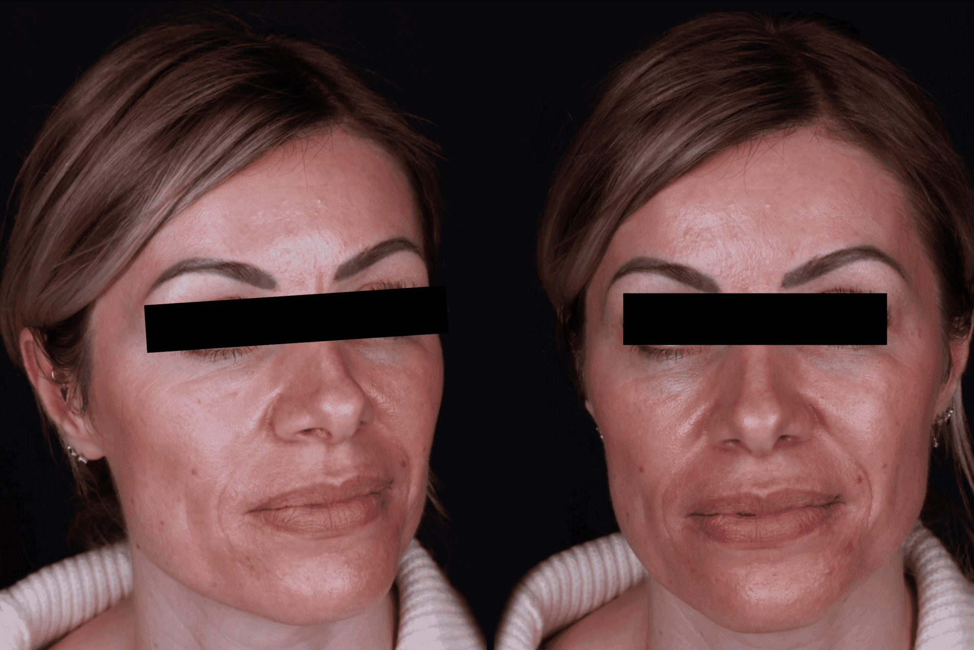 Botched Tear Trough Filler: Dr MJ’s Top Tips for Correction